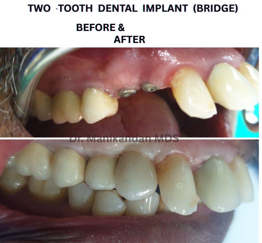Dental Implants - Tooth Town Dental Clinic