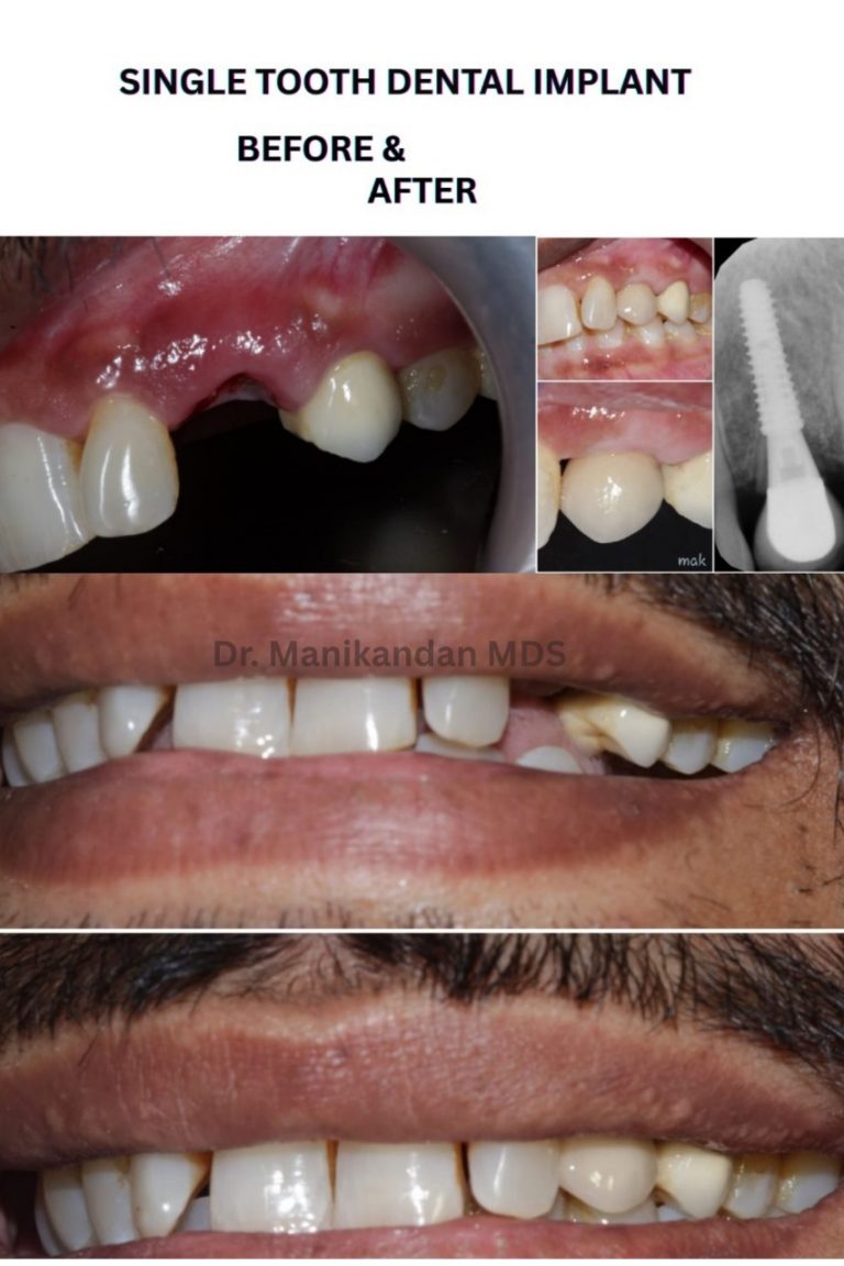 Dental Implants - Tooth Town Dental Clinic