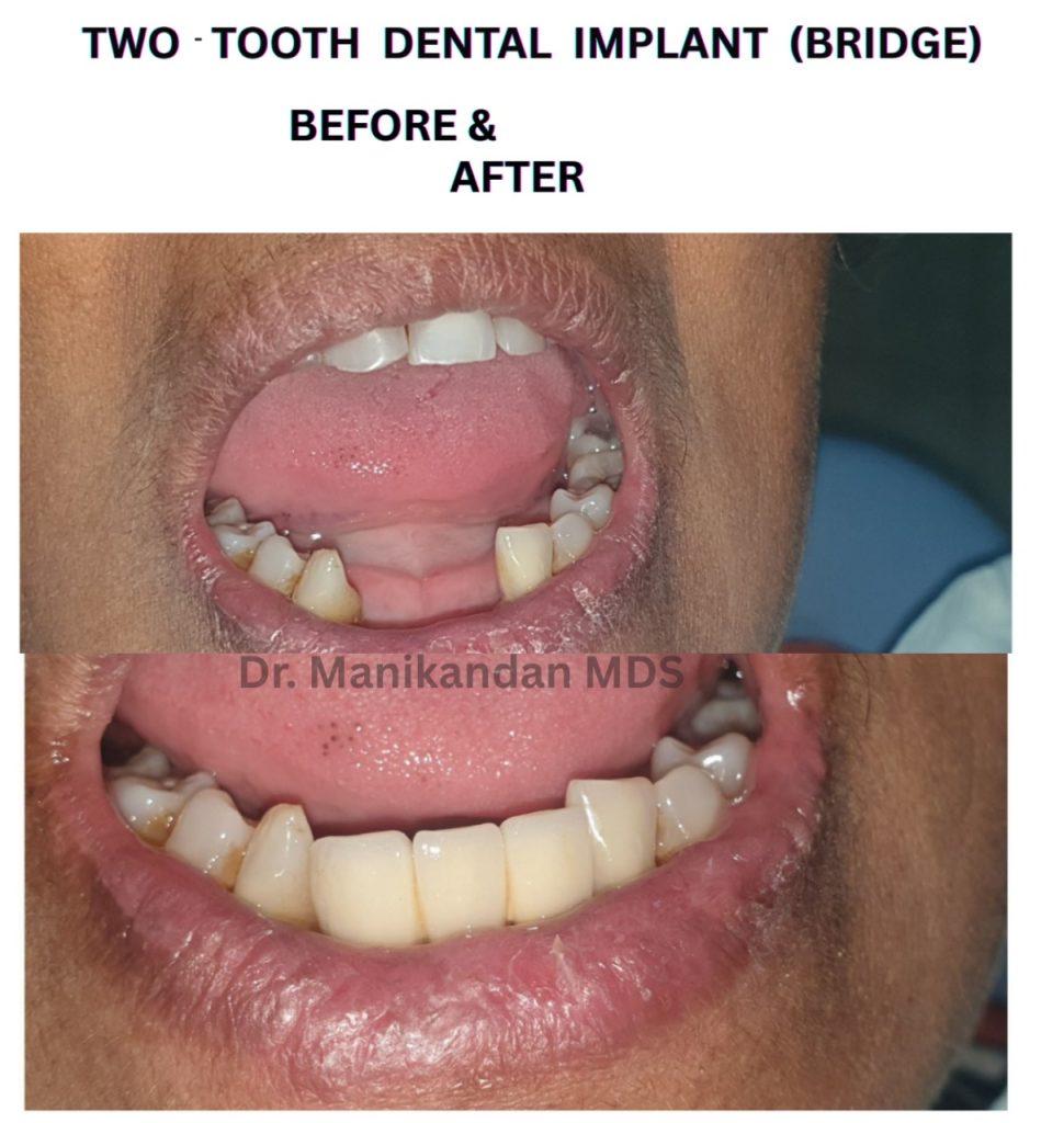 Dental Implants - Tooth Town Dental Clinic