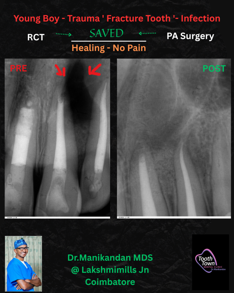 Root Canal Treatment - Tooth Town Dental Clinic